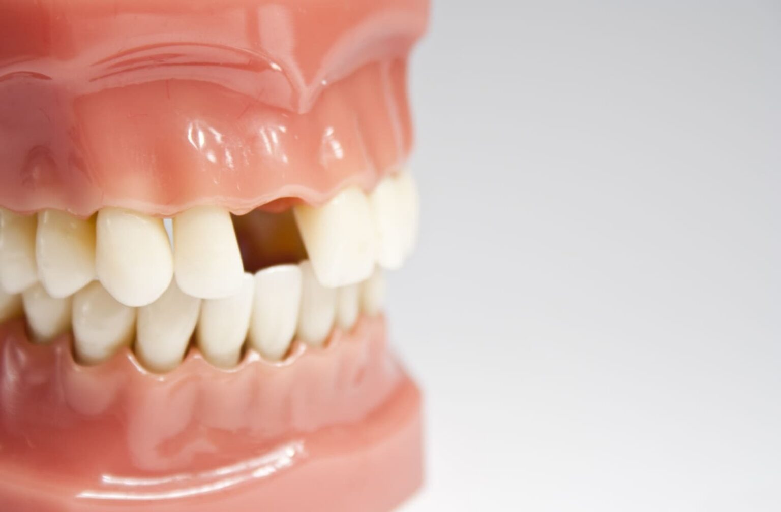 5 Single Tooth Replacement Options | Generations Dental